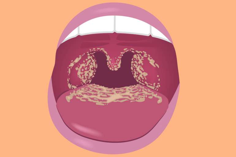 All you have ever wanted to know about Candidiasis - Nutri Health Solutions
